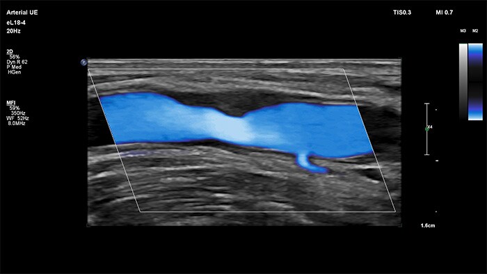 Vascular Ultrasound System Portfolio| Philips Healthcare